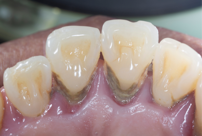 ¿Qué es el sarro? ¿Cómo saber cuando tengo sarro? Tipos de sarro y las ...